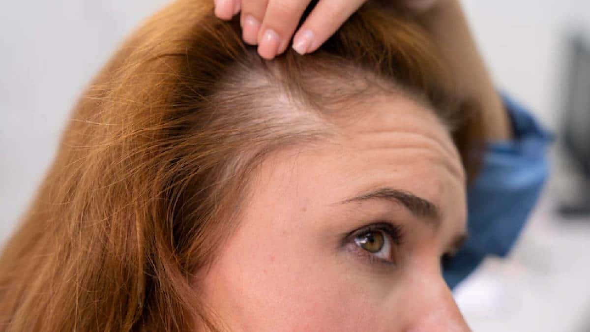 ¿cómo Prevenir La Caída Excesiva De Cabello